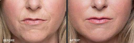 Juvederm Before And After Photos